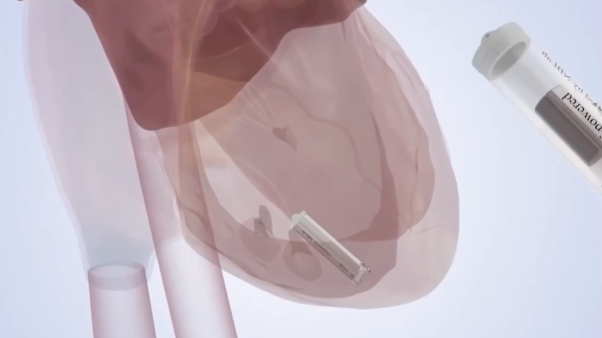 Heartbeat-Powered Pacemaker Promises Longer-Lasting Cardiac Implants ...